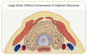Goiter - Larian, MD