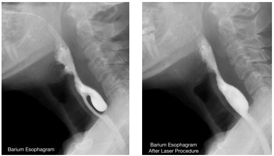 Zenker's Diverticulum Surgery - Larian, MD