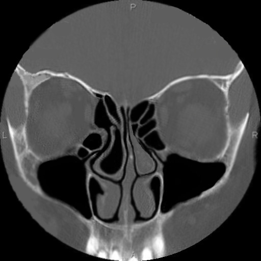 Targeted Endoscopic Sinus Surgery - Larian, MD