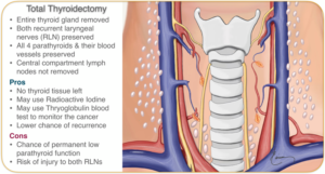Minimally Invasive Thyroidectomy - Larian, MD