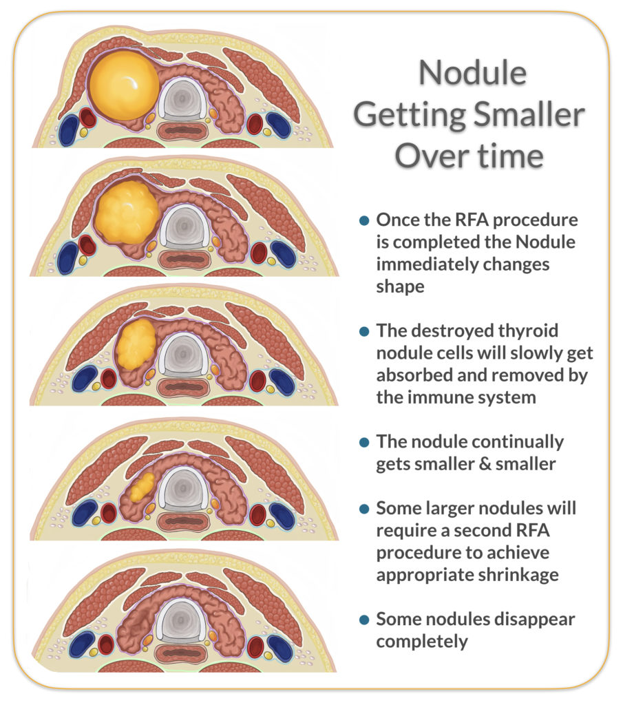 Thyroid Nodule RFA - Larian, MD